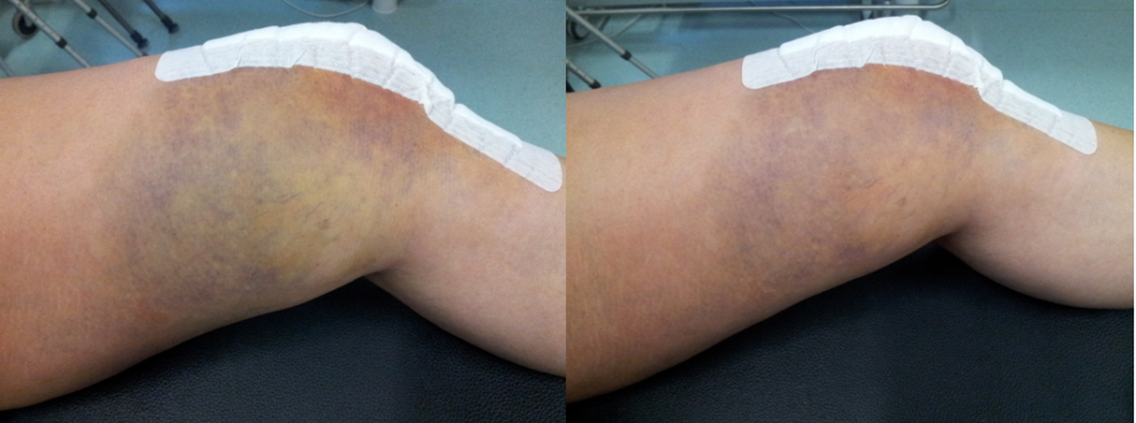 LymphaTouch - AlfaCare AS - Helse, sport og fritid!